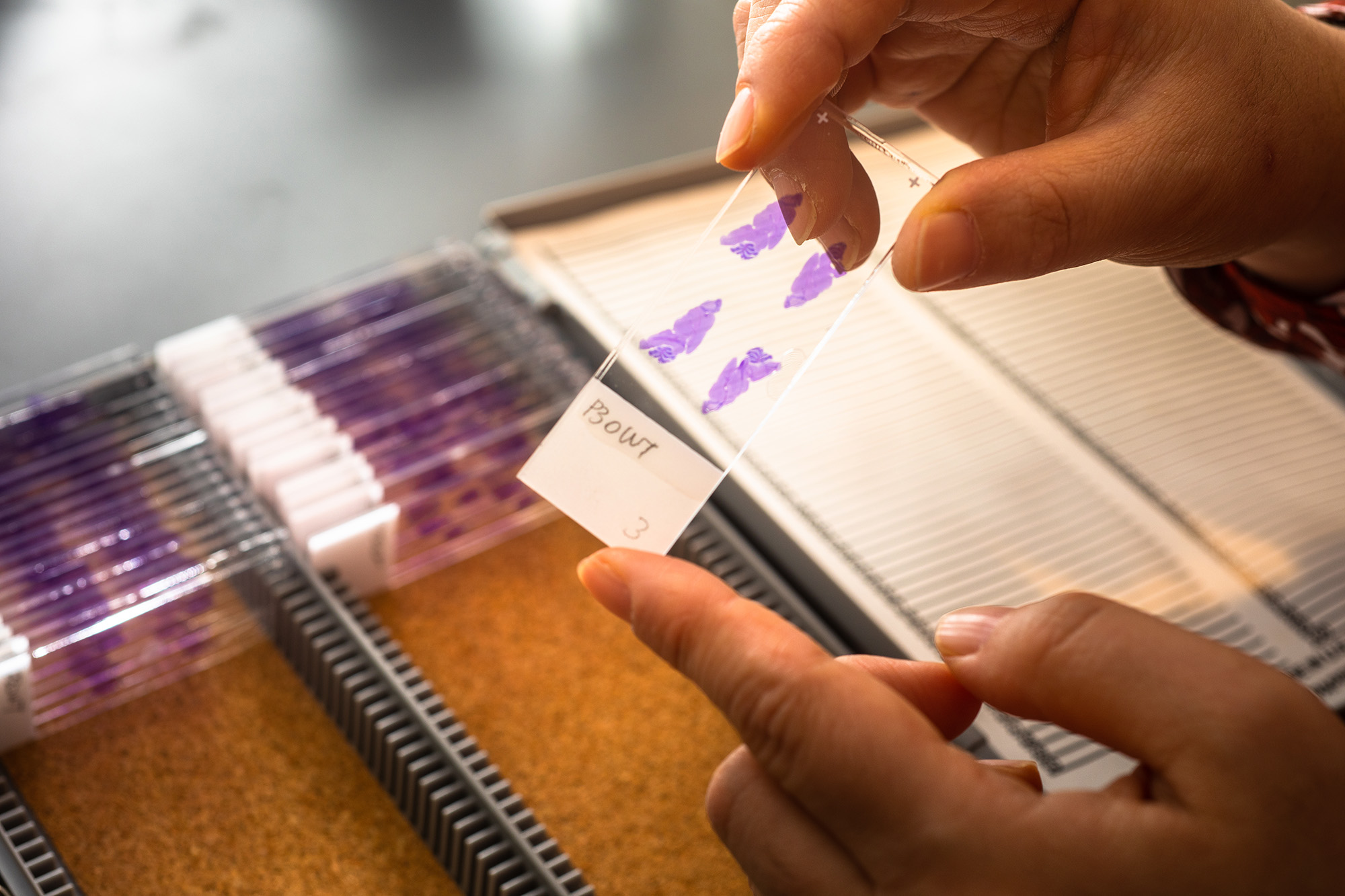 For two UB scientists, love means studying their daughter’s rare ...